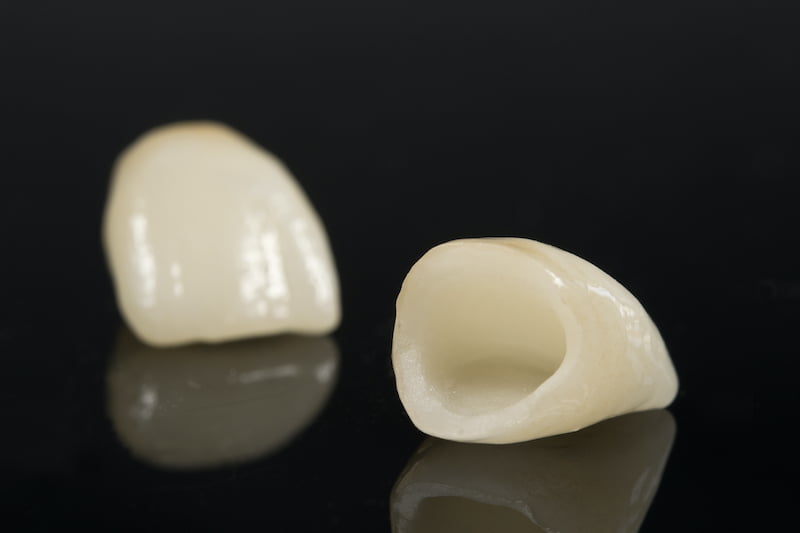 Ceramic Crowns - Your Caring Sunshine Coast Dentist - Hinterland View ...